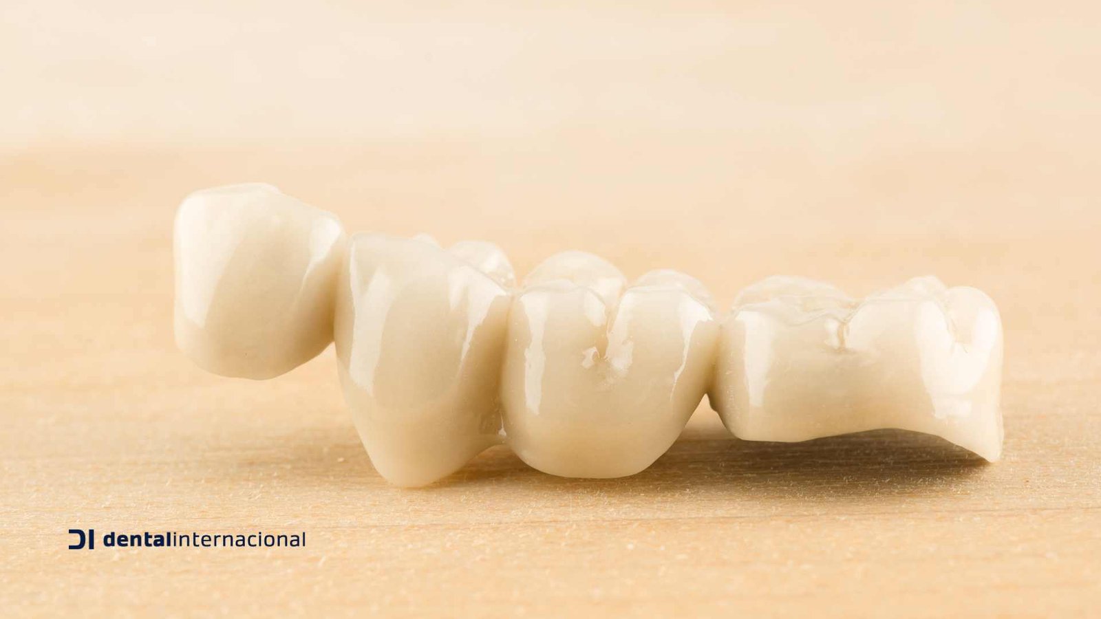 ¿Qué es un puente dental fijo y cuál es su función?